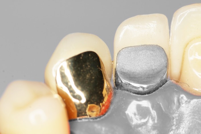 1. Zahnkronen – technoDENT