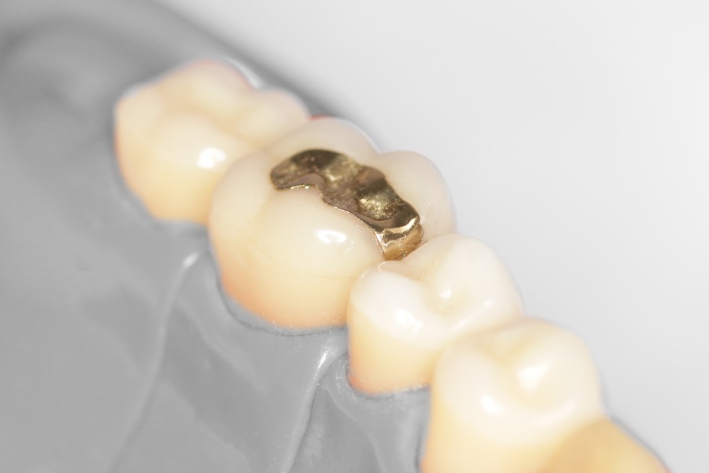 1. Zahnkronen – technoDENT