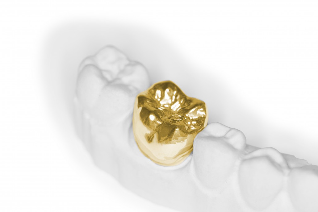 1. Zahnkronen – technoDENT