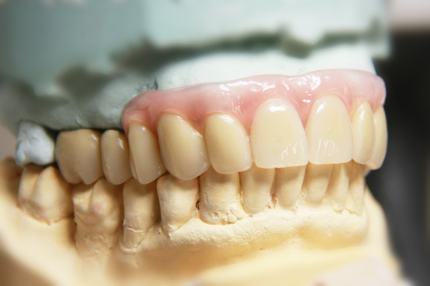 4. Teilprothesen – technoDENT