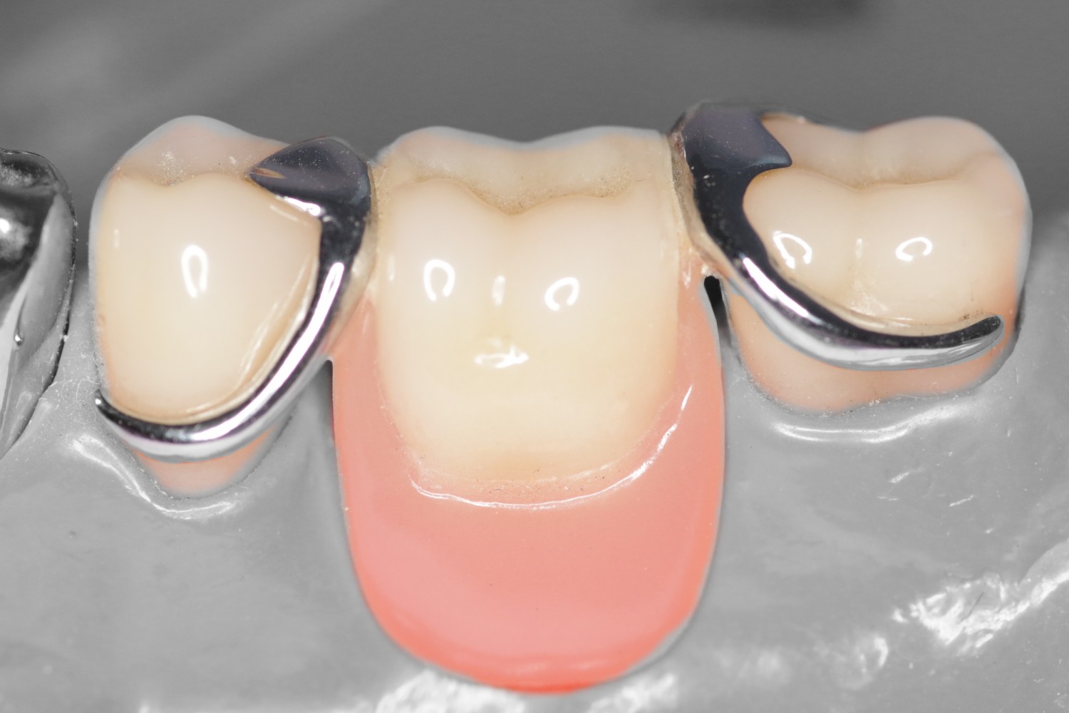 4. Teilprothesen – technoDENT