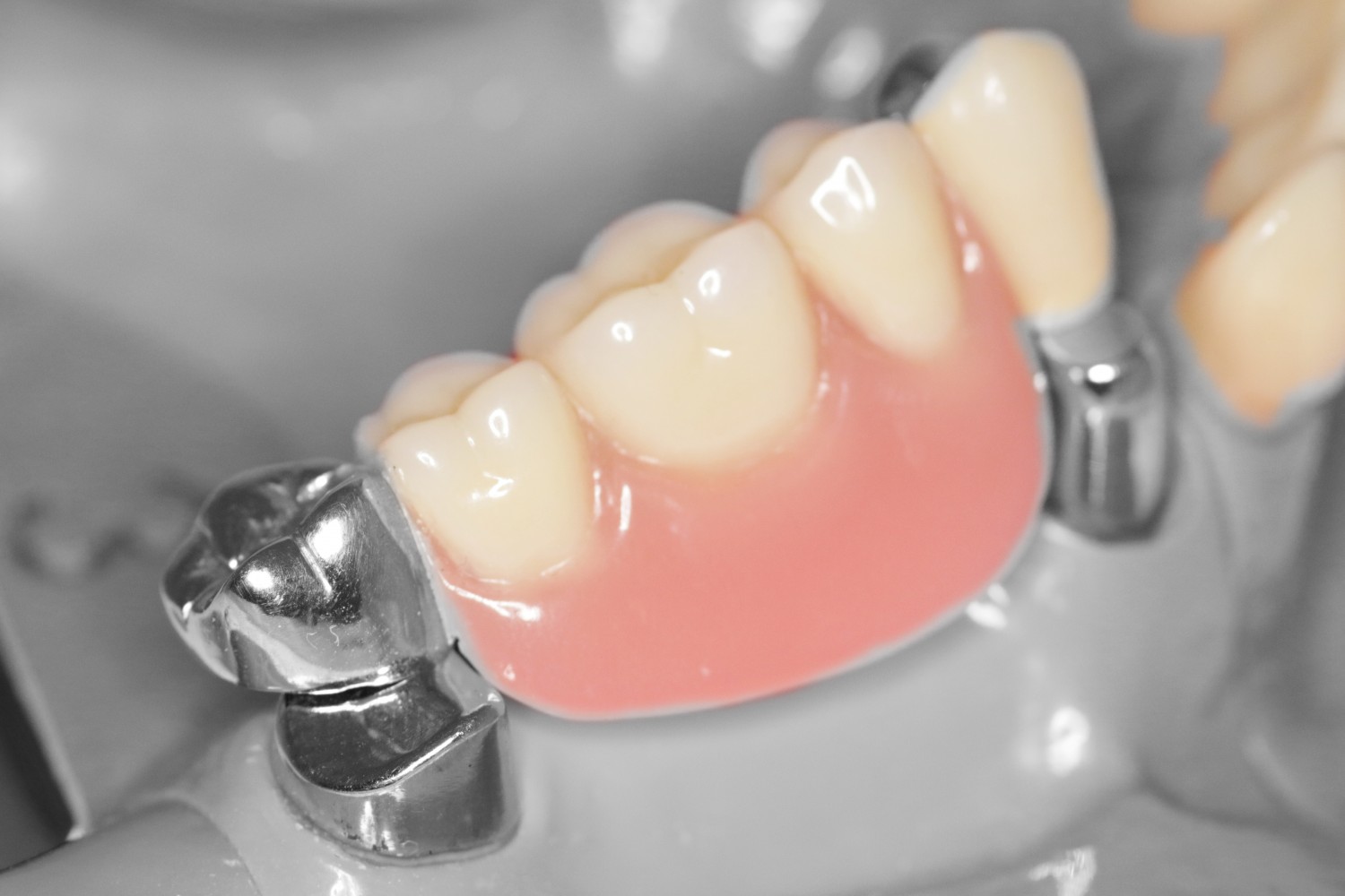 4. Teilprothesen – technoDENT