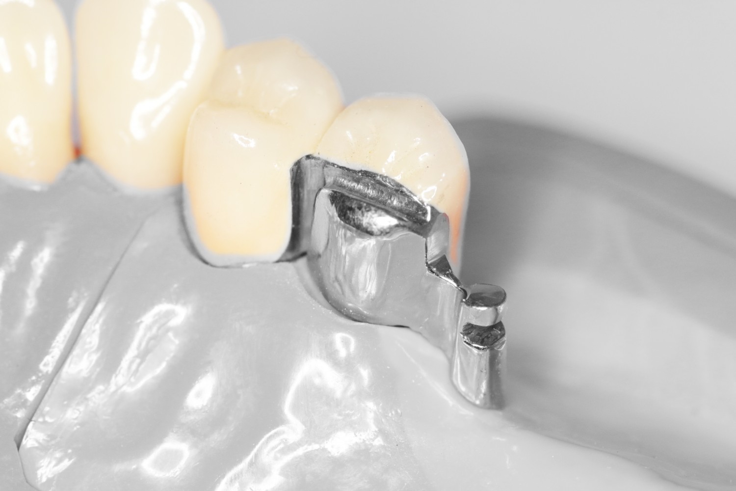 4. Teilprothesen – technoDENT