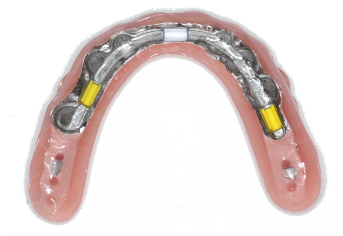 6. Implantatprothesen – technoDENT