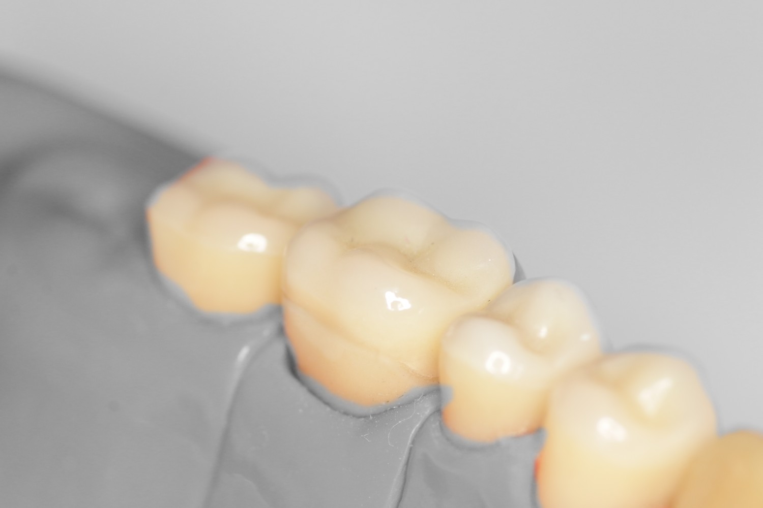 1. Zahnkronen – technoDENT