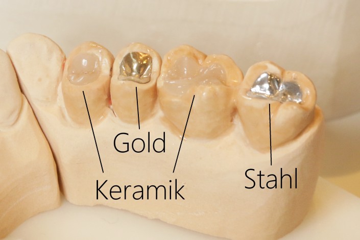 1. Zahnkronen – technoDENT