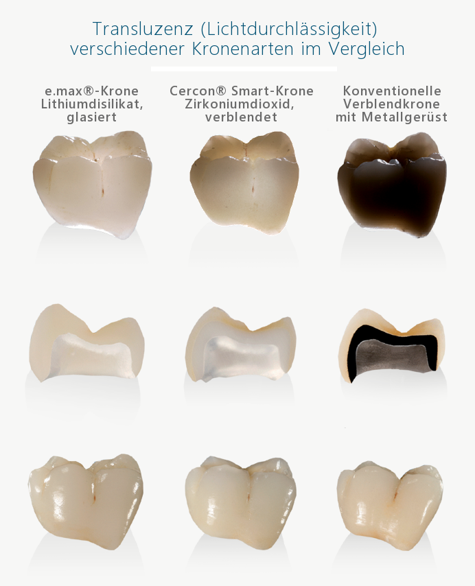 e.max® Press – technoDENT